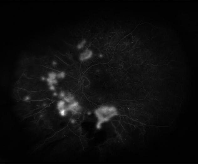 Uveitis - Foundation For Vision Research