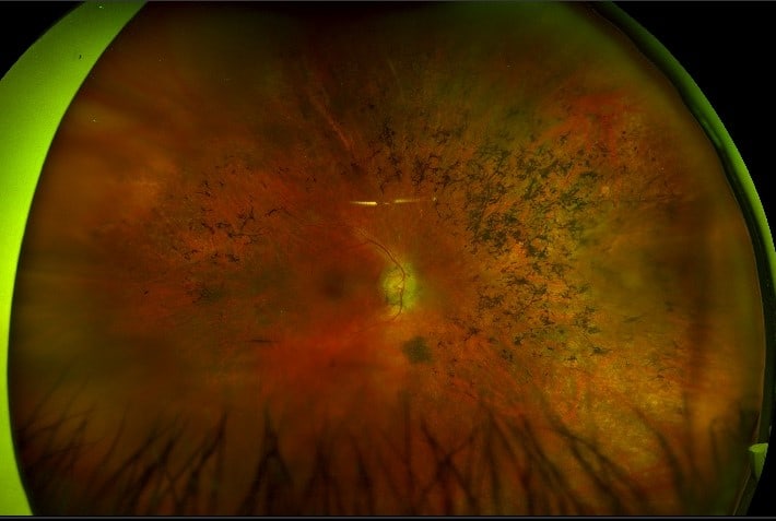 Inherited Retinal Diseases - Foundation For Vision Research
